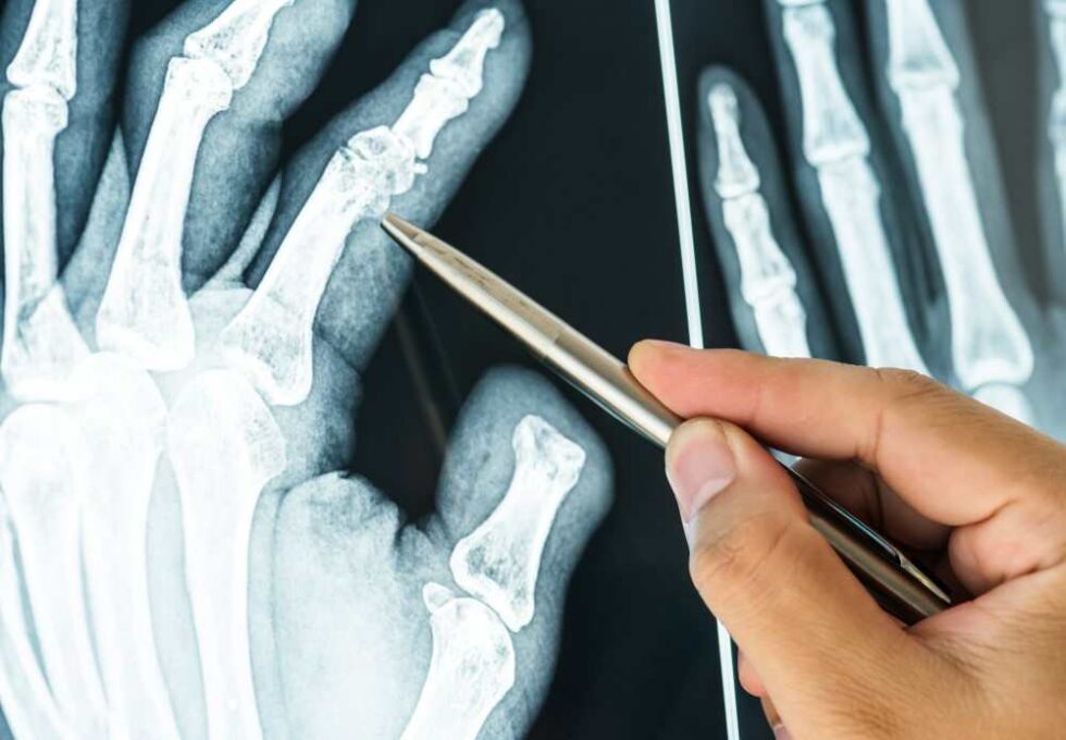 Doigt cassé : Symptômes et que faire - santechiro.fr