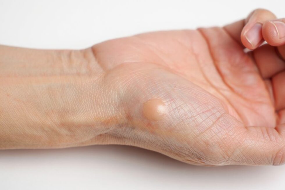 Kyste synovial au poignet : Symptômes, causes et traitement - santechiro.fr
